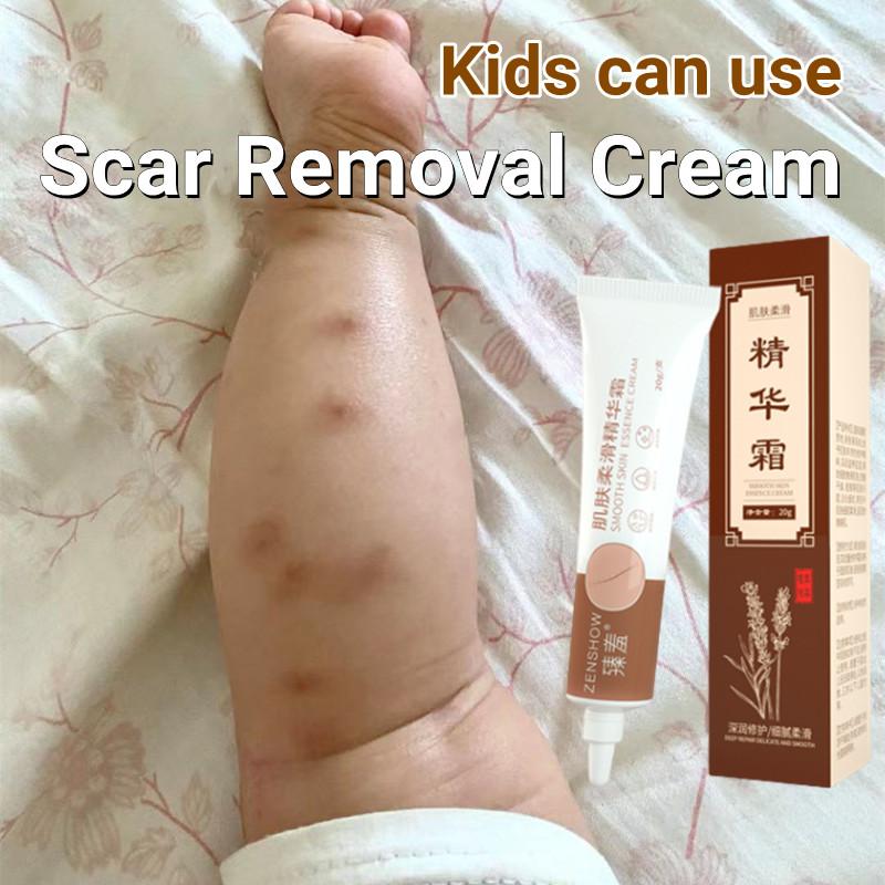 Krim Hilangkan Parut Hitam Bayi Scar Removal Cream Scar Repair - TikTok ...