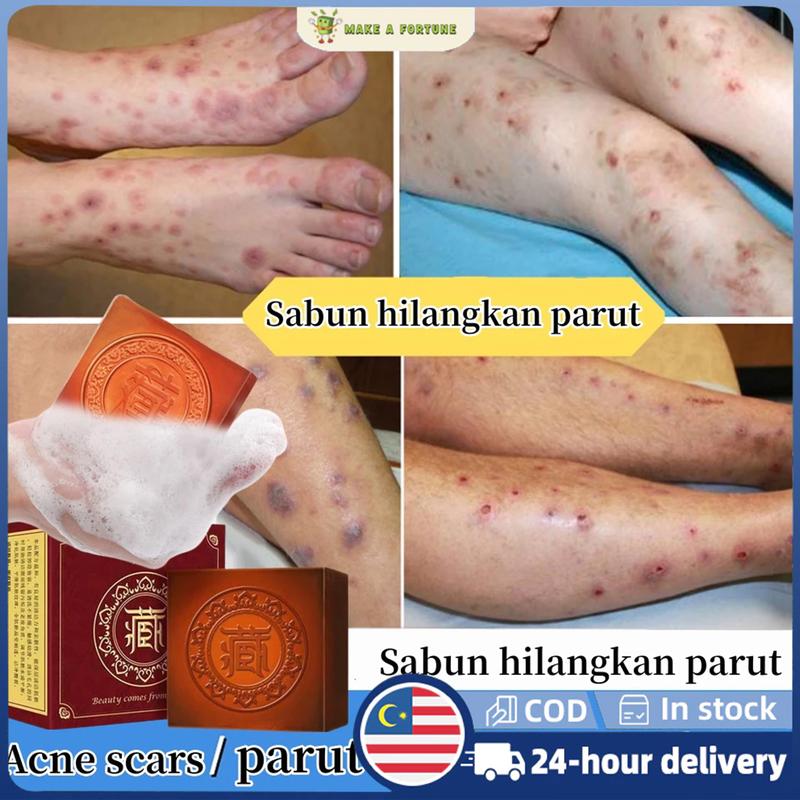 【MAKE A FORTUNE】Sabun hilangkan parut Sabun hilangkan parut kudis ...
