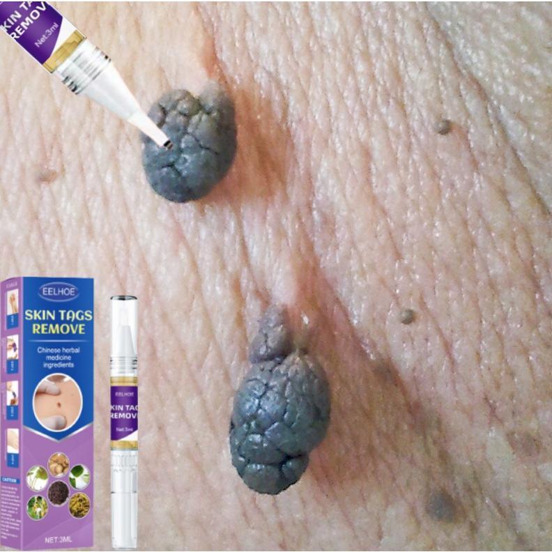 Warts Removal Pen Painless Fast Dark Spot Flat Remov eiquid Skin ...