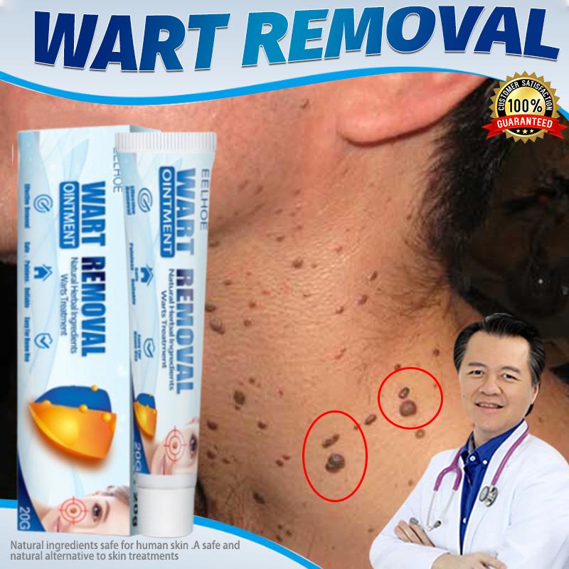 EELHOE Wart remover Buang tahi lalat ketuat kutil Biji kolestrol ...