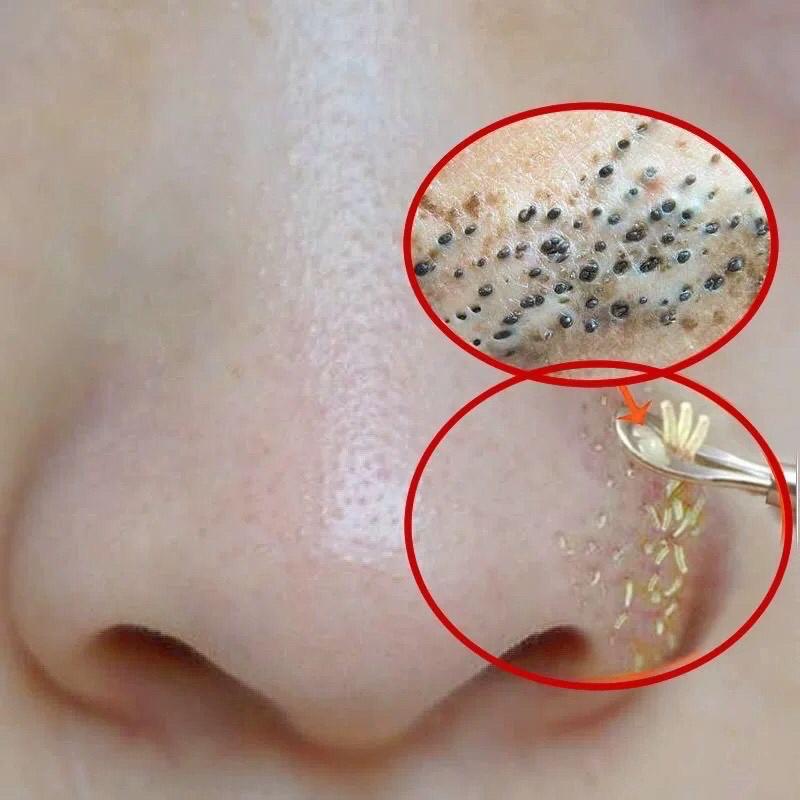 BLACK MASK BLACKHEAD WHITEHEAD masker tarik jerawat dan whitehead ...