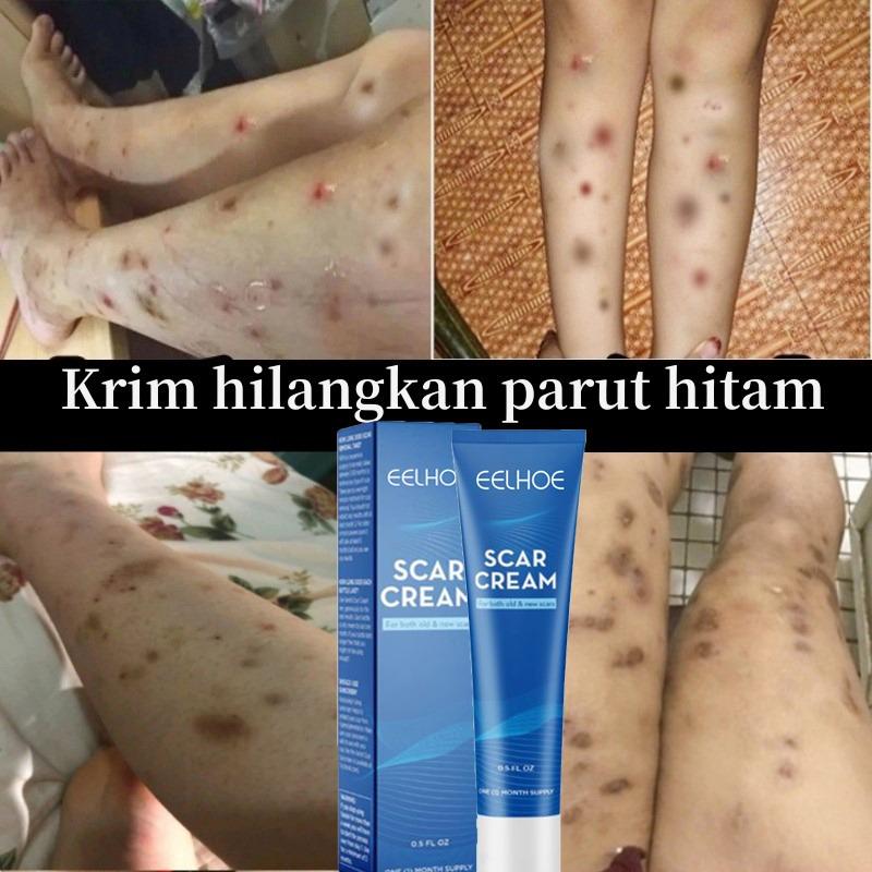 salep penghilang bekas luka lama salep keloid paling ampuh 15g - Shop | Tokopedia