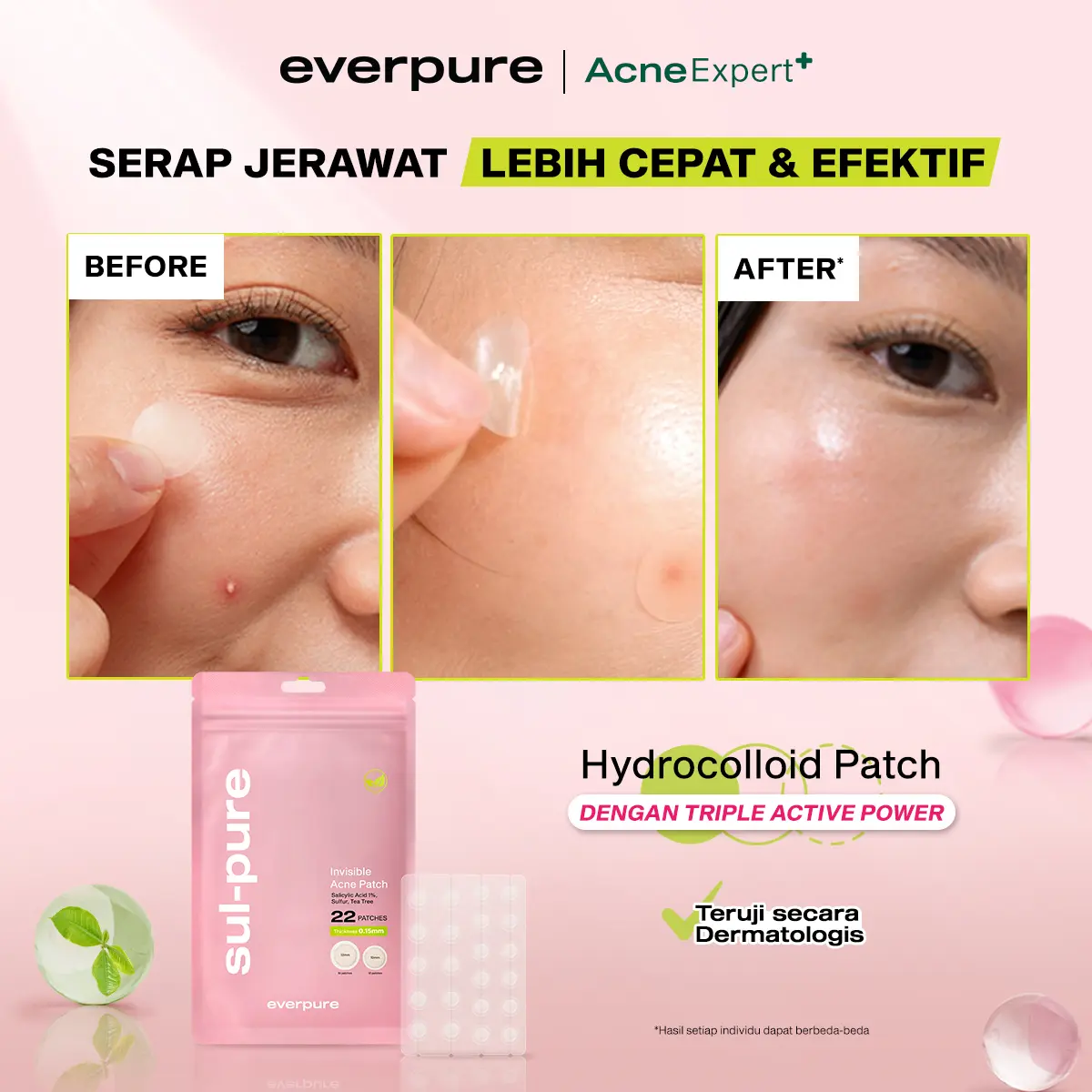 [Exclusive Tiktok] EVERPURE Acne Rescue Kit Bundle | Sulpure Invisible ...