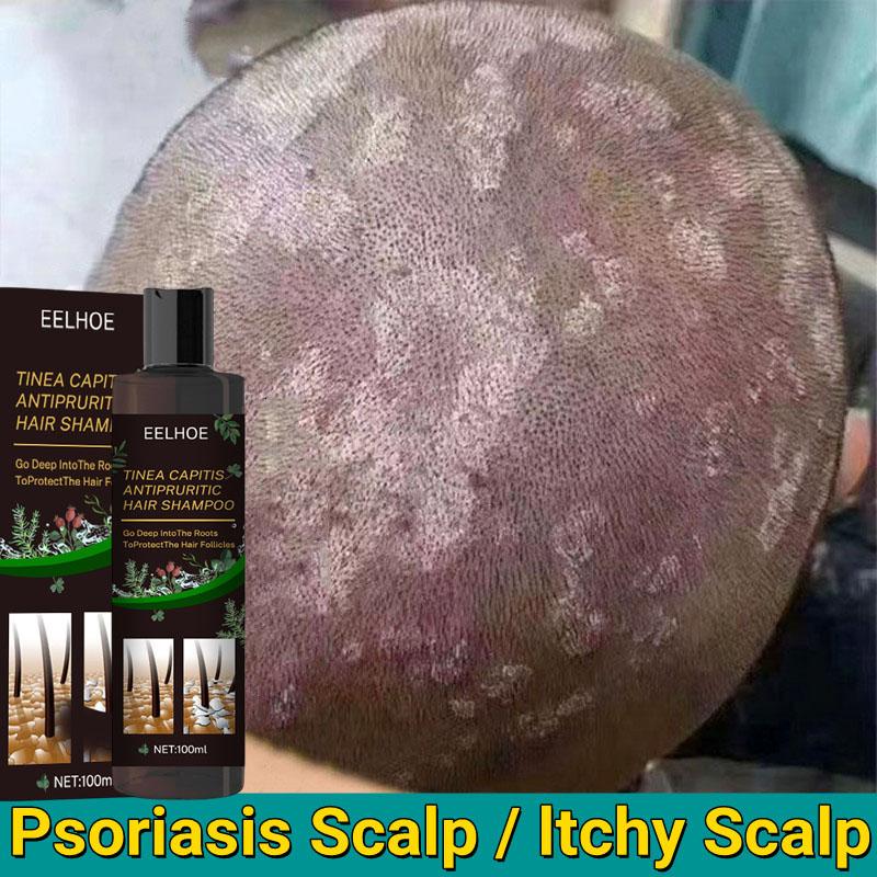 Psoriasis scalp Itchy scalp Antifungal shampoo Scalp treatment - TikTok ...