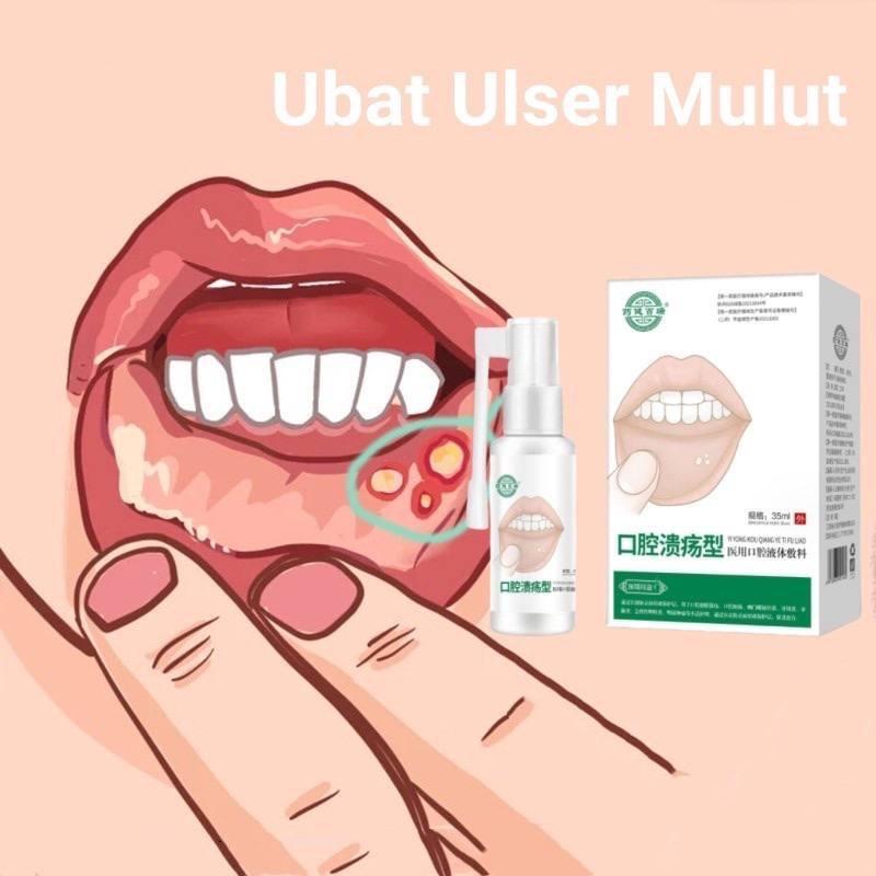 Mouth Ulcer Spray Spray anti-ulser mulut Melindungi luka ulser - TikTok ...