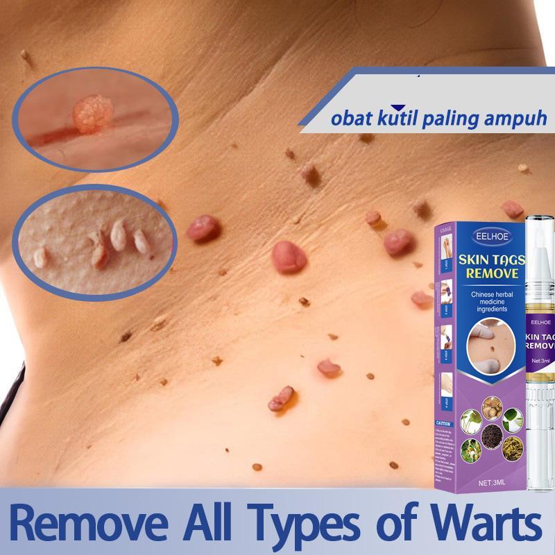 Ubat ketuat Tahi lalat remover Skin tag remover Buang tahi lalat ...