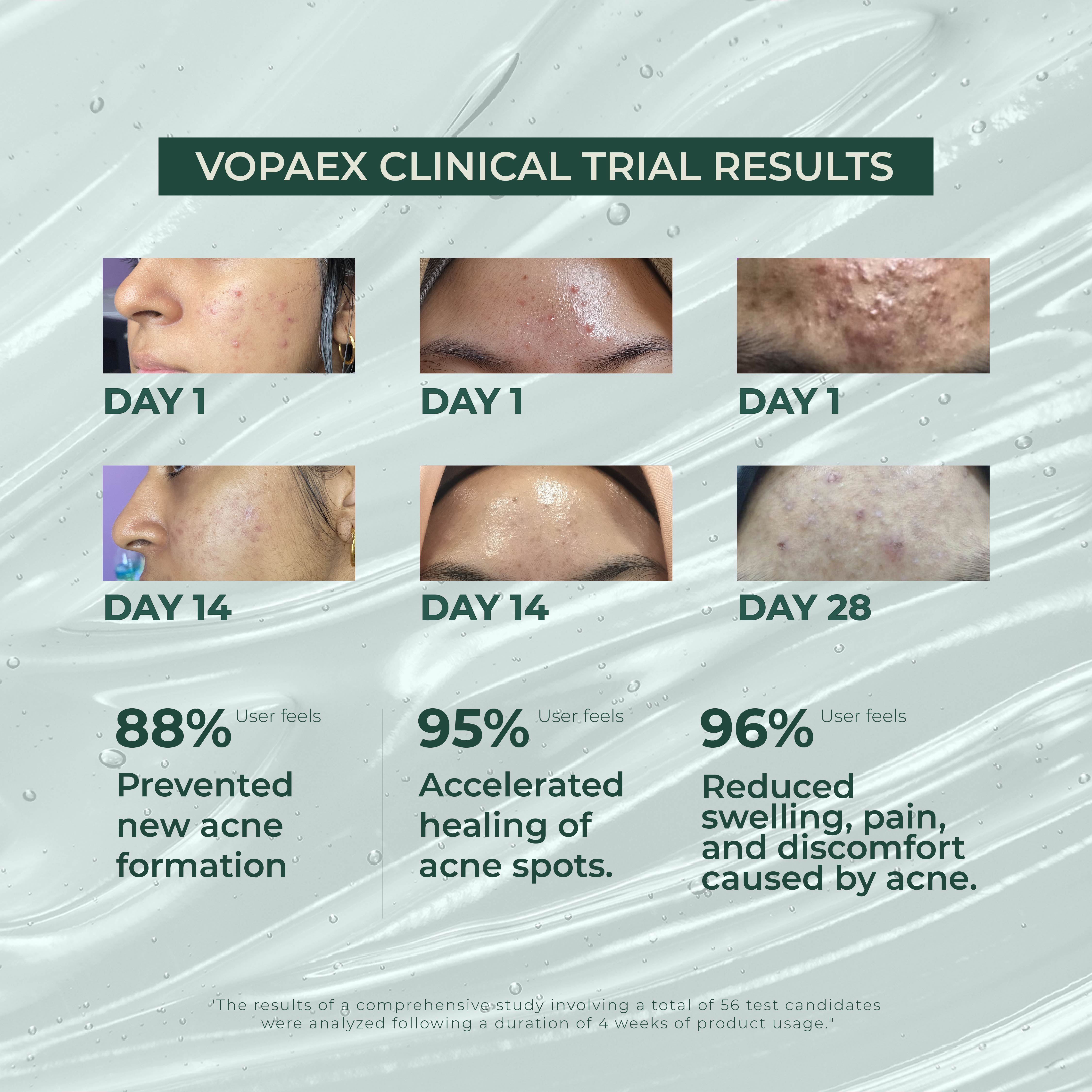 SOS ACNE SPOT GEL – Healez Sdn Bhd