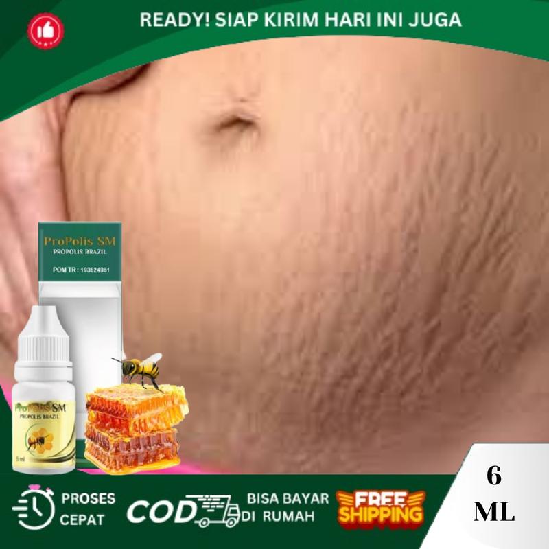 Propolis SM - Garis Hitam Perut Kerutan Hitam Diperut Streck Mark ...
