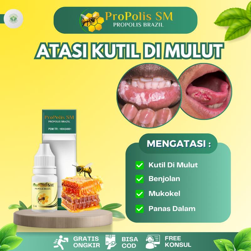 Propolis SM - Perawatan Untuk Kutil Di Mulut, Daging Jadi, Benjolan ...