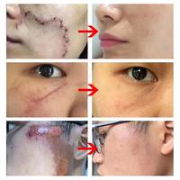 Jual Silicone scar sheet Penghilang keloid Penghilang bekas luka hitam ...