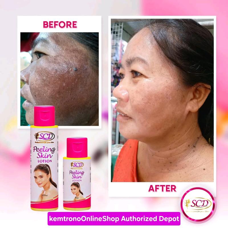SCD Skin Peeling Lotion New Pack 50ml / 100ml Whitening New Pack ...
