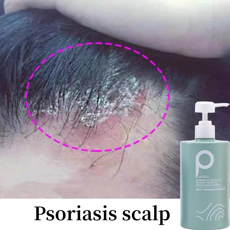 Syampoo kelemumur dan gatal kepala Psoriasis scalp Itchy scalp - TikTok ...