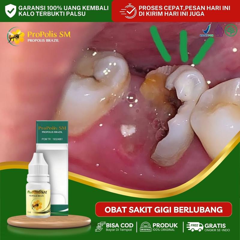 Obat Sakit Gigi Berlubang, Sakit Gigi Dan Gusi, Gigi Keropos, Gigi ...