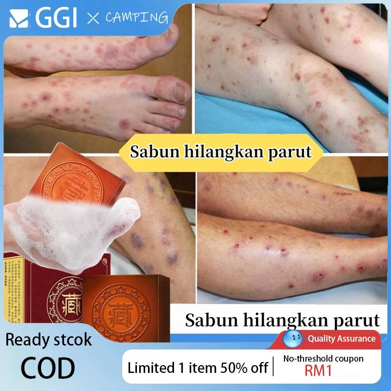 【GGI】Sabun penghilang hama Penjagaan Kulit Parut Rawatan Jerawat ...