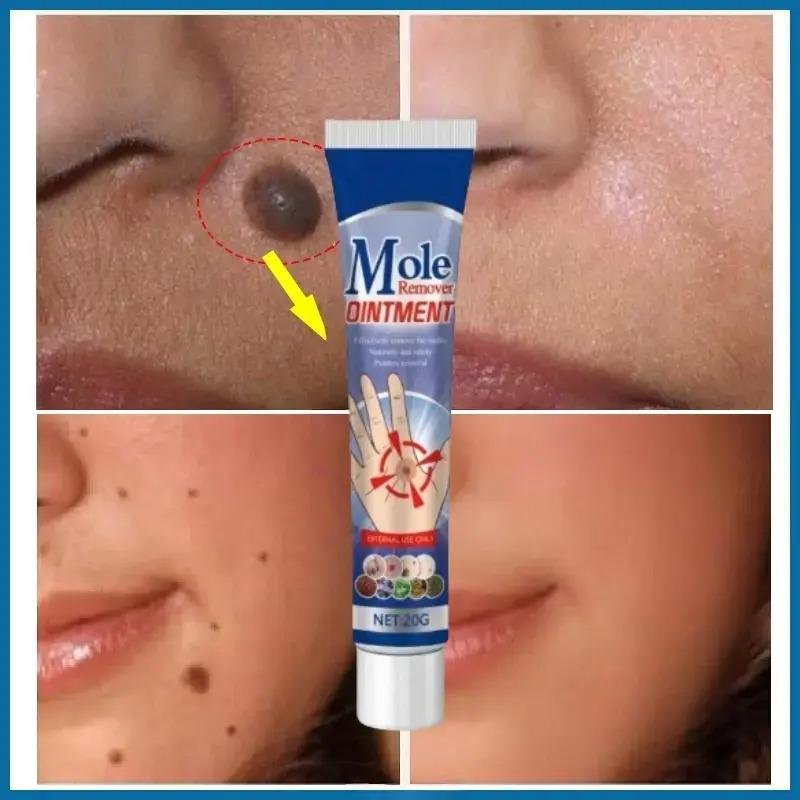 Penghilang Tahi Lalat Di Wajah Penghilang Kutil Di Leher Salep Kutil ...