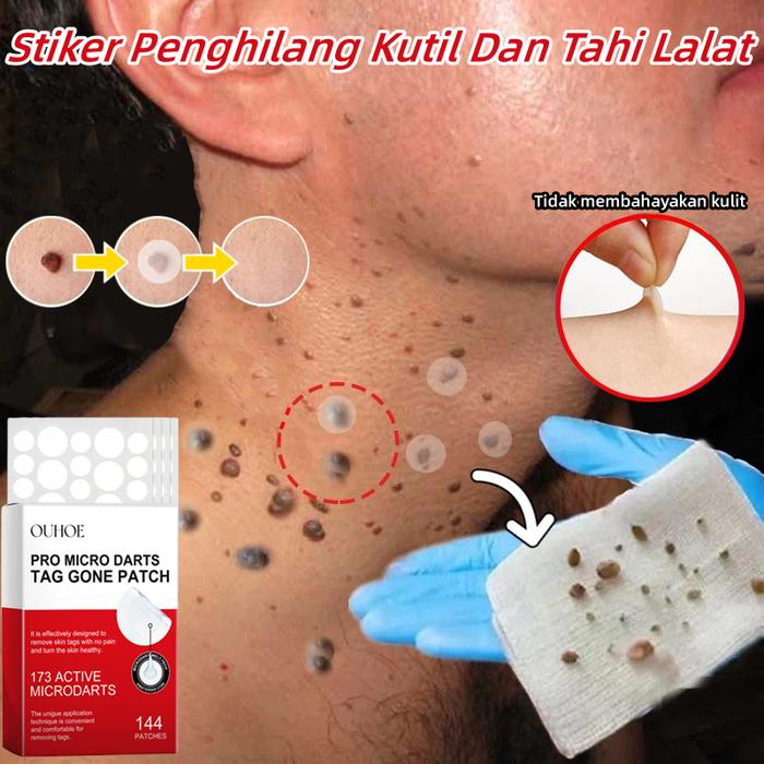 Jual Sticker Penghilang Kutil Dan Tahi Lalat Patch Penghilang Kutil ...
