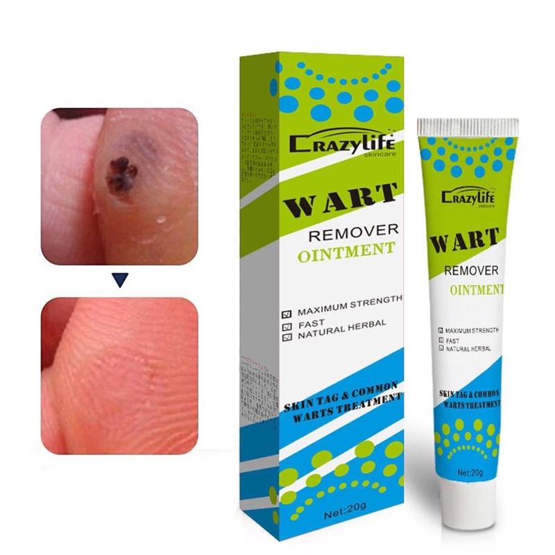 WART REMOVER CREAM corn remover krim penanggal kutil ketuat Skin ...