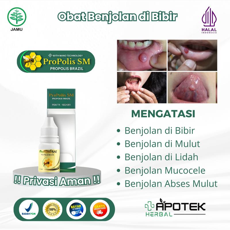 Propolis SM Atasi Benjolan di Bibir Mulut dan Lidah Kista Mukokel Gusi ...