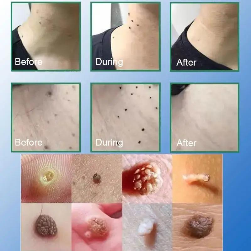 Penghilang Tahi Lalat Di Wajah Penghilang Kutil Di Leher Salep Kutil ...