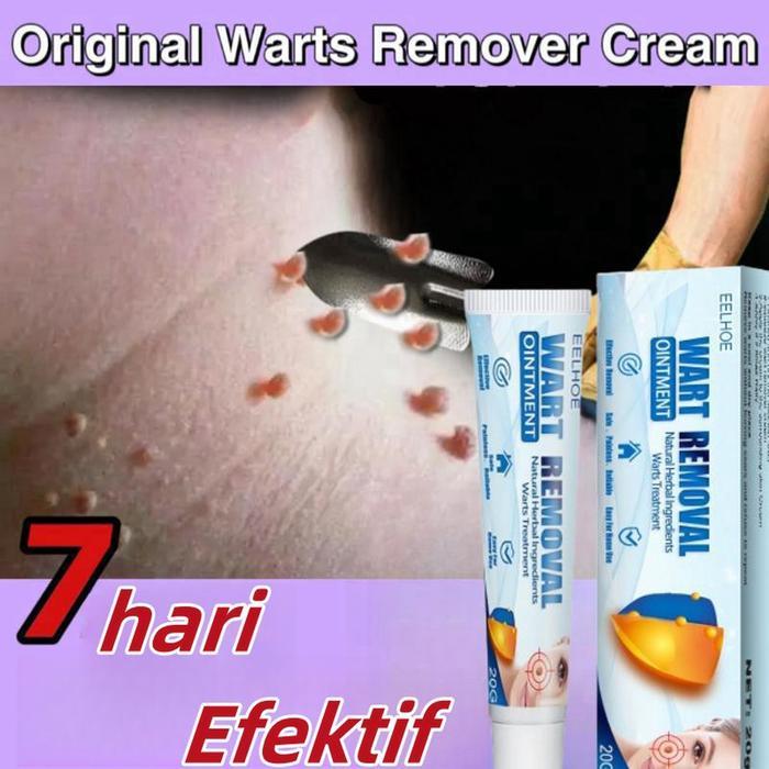 Krim Penghilang Kutil Wart Cream Lepaskan Daging Di Bawah Ketiak Tangan ...