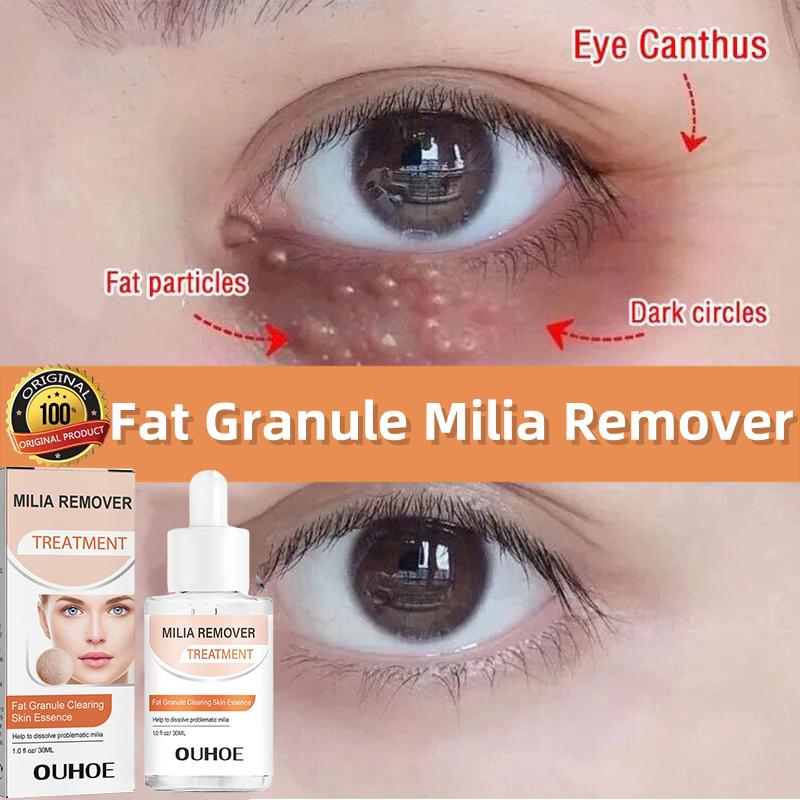 Original Milia seed remover fat granule eye treatment repair - TikTok ...