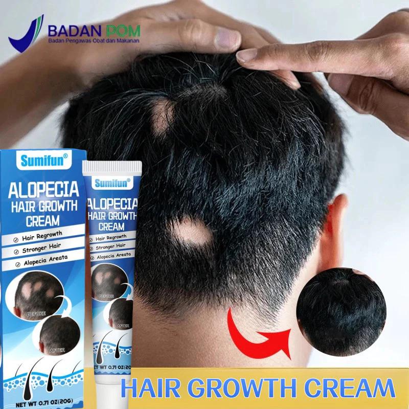 Obat Alopecia Areata Hair Growth Cream Penumbuh Rambut Cepat untuk Pria ...