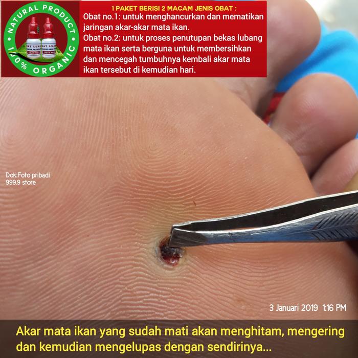 Jual Obat penyakit mata ikan atau clavus bukan plester salep callusol ...
